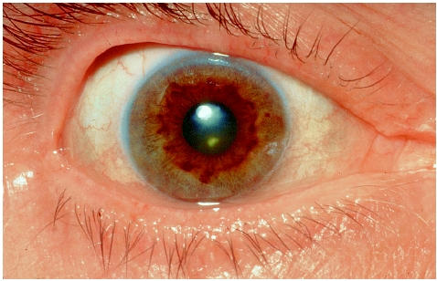 Medbizarre: Wilson's Disease