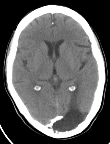 Intradiploic Epidermoid with Intracranial Extension - Sumer's Radiology ...