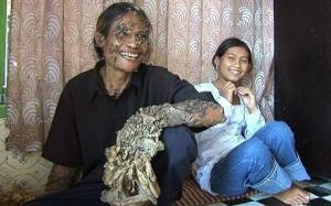 Amazing Earth: Tree Man of Indonesia
