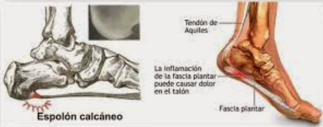 BLOG QUAE SUNT OFICIAL: TALALGIA O DOLOR DE TALÓN