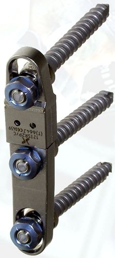 Spine Update 脊椎新事: DYNAMIC STABILIZATION?