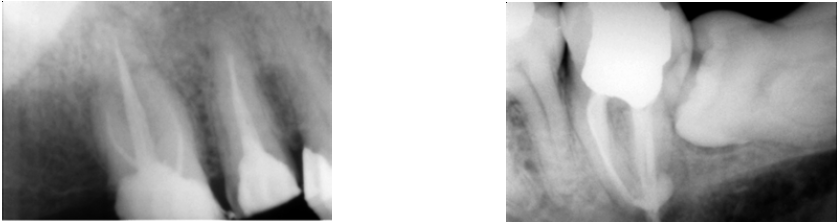 Basics of Obturation - Endodontics and Oral Implantology
