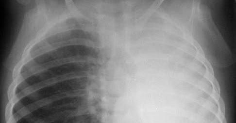 BDS INSIGHTS: Atelectasis Partial lung collapse
