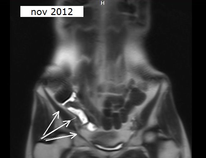 hourglass gallbladder