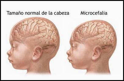 Malformaciones congenitas UO: MICROCEFALIA
