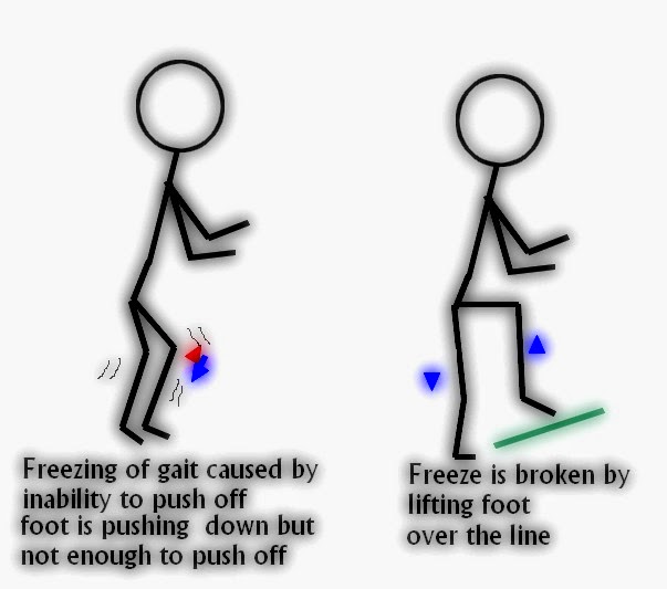 Freezing of Gait