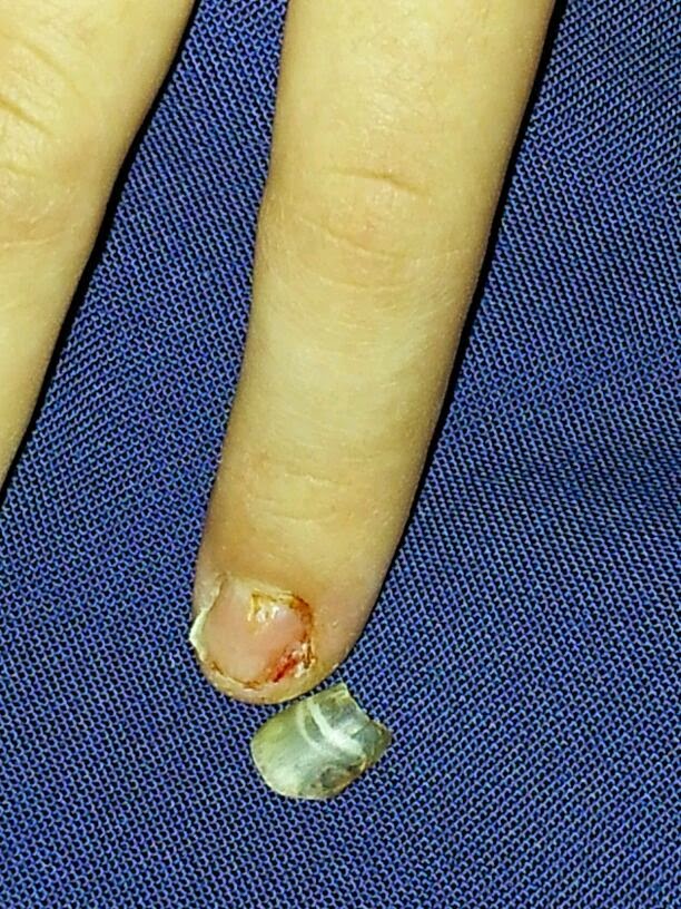 Tio's Little Ones: Nails Falling Out - The Aftermath of A Blistering Time