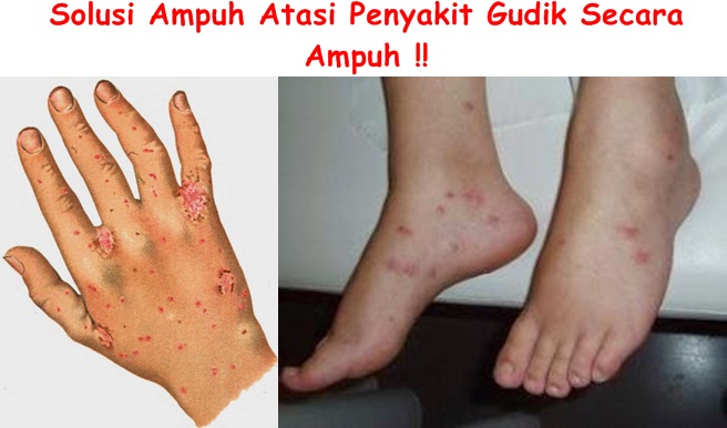 Obat Tradisional Gudik ~ Agen Resmi Balikpapan