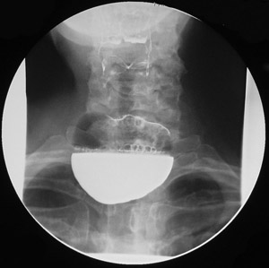 Normal Radiological Appearance After Endoscopic Treatment of Zenker's ...