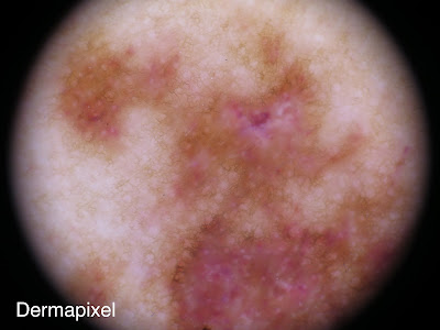 Dermapixel: junio 2018