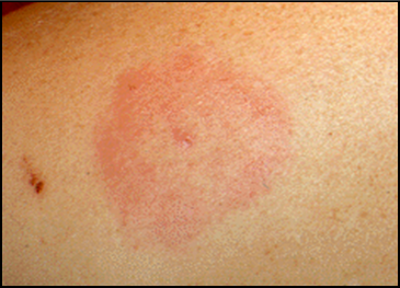 The Safety Queue: The threat of Lyme Disease
