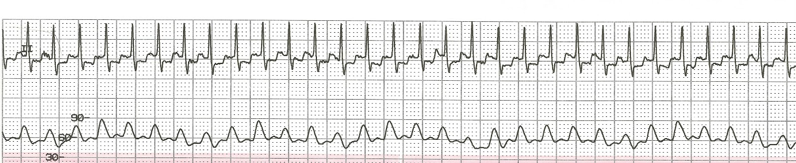 EKG Rhythm Strips of Unstable SVT with Arterial Blood Pressure Waveform