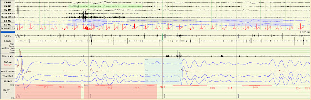 Sleep and Neurology: Cardiac Variability at Night During Apneas ...