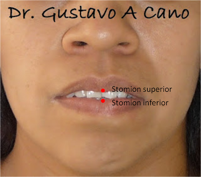 Blog de ortodoncia en fotografías - Orthodontic pictures : Stomion ...