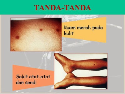 Selamat Datang ke SK Pekan Satu: DENGUE PATROL : TANDA-TANDA DEMAM DENGGI