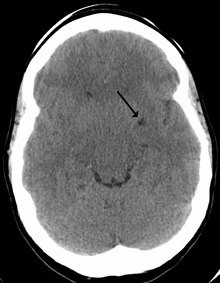 Neuroglia Lab : Glymphatics and virchow-robin space