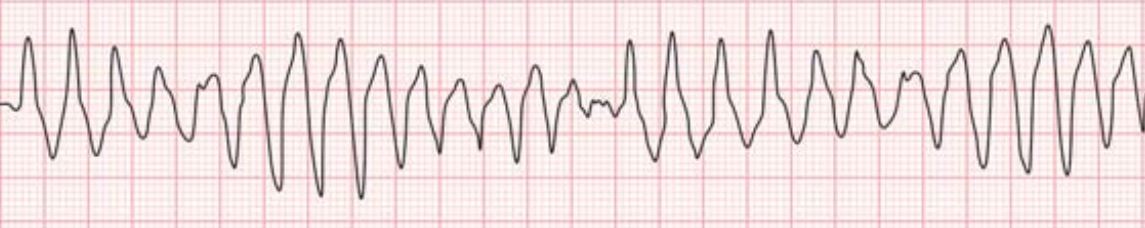Torsades de pointes - twisting of the points