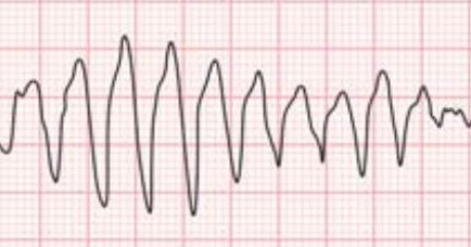 Torsades de pointes - twisting of the points