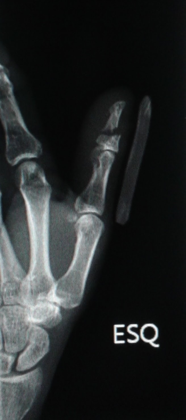 DICAS DE RADIOLOGIA: IMAGENS RADIOLÓGICAS - FRATURA DA FALANGE DISTAL ...
