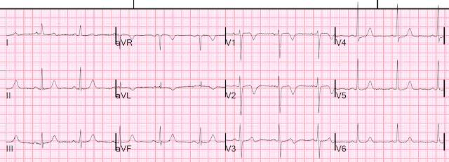 Dr. Smith's ECG Blog: Chest pressure during exertion, evolution of ...