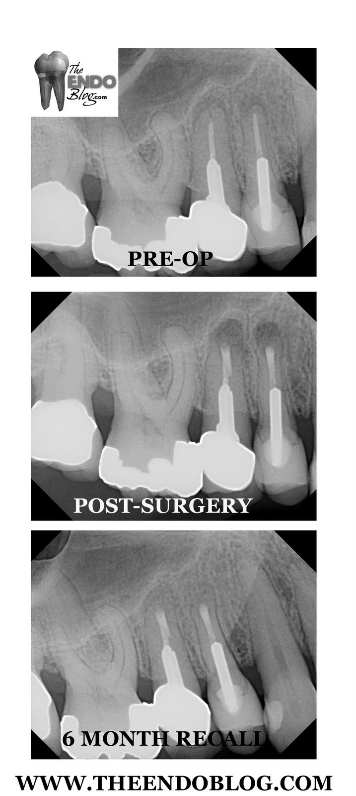 The Endo Blog: Success with endodontic surgery (apicoectomy)