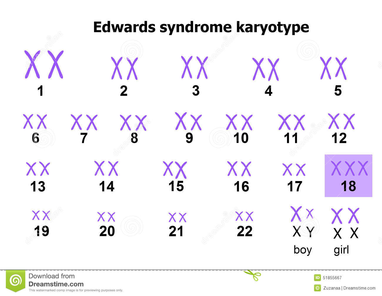 Cusevi y Pemaco: Síndrome de Edwards