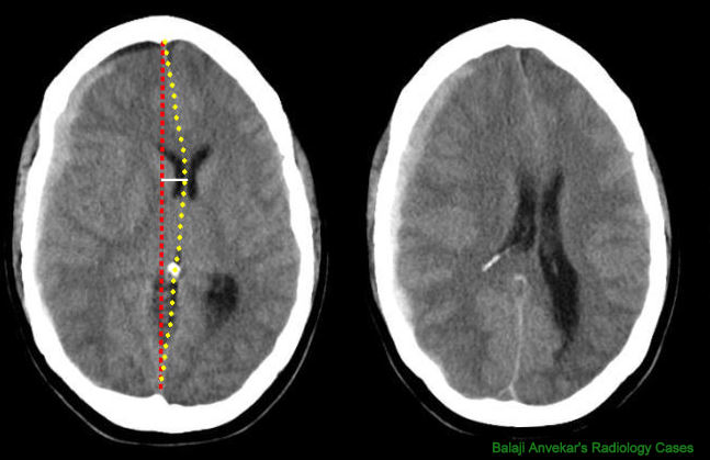 Brain Bleed: Mid Brain Bleed
