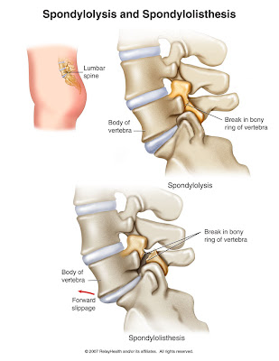 Medische Kennis: Spondylolysis en spondylolisthesis