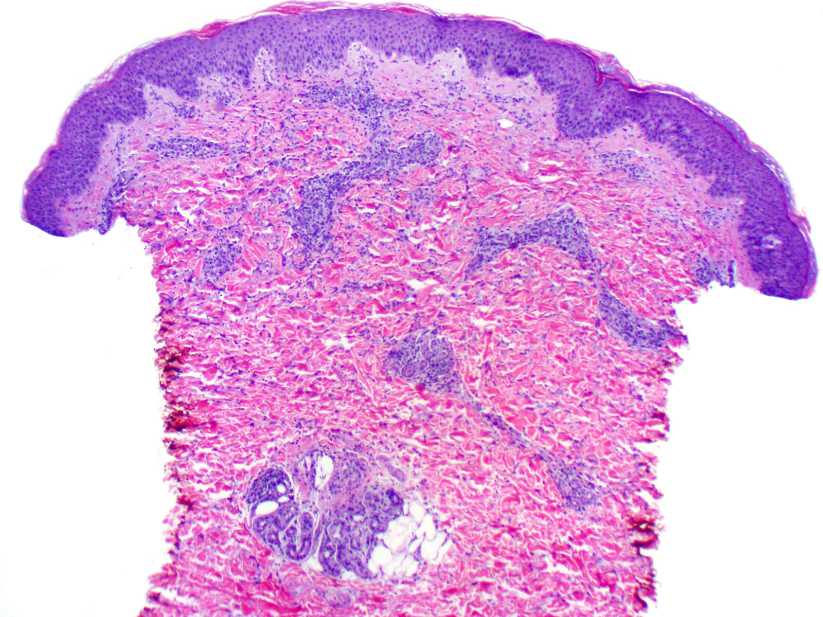 VIRTUAL GRAND ROUNDS IN DERMATOLOGY 2.0: Interstitial Granulomatous ... VIRTUAL GRAND ROUNDS IN DERMATOLOGY 2.0: Interstitial Granulomatous ...