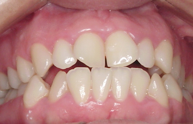 MORFOLOGIA OCLUSAL: CLASIFICACION DE ANGLE
