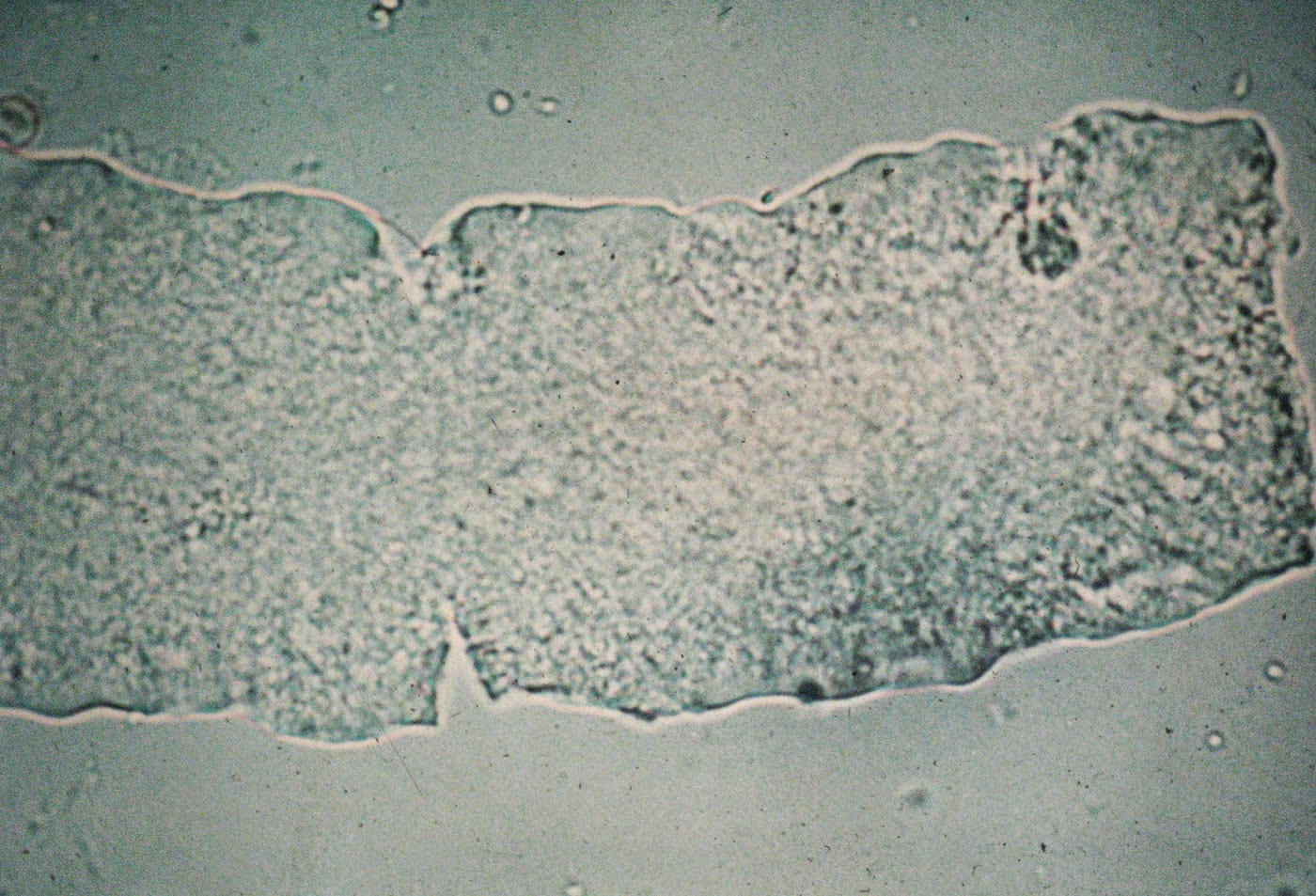 USMLE COMLEX Study Guides : Renal Pathology: Glomerular Diseases