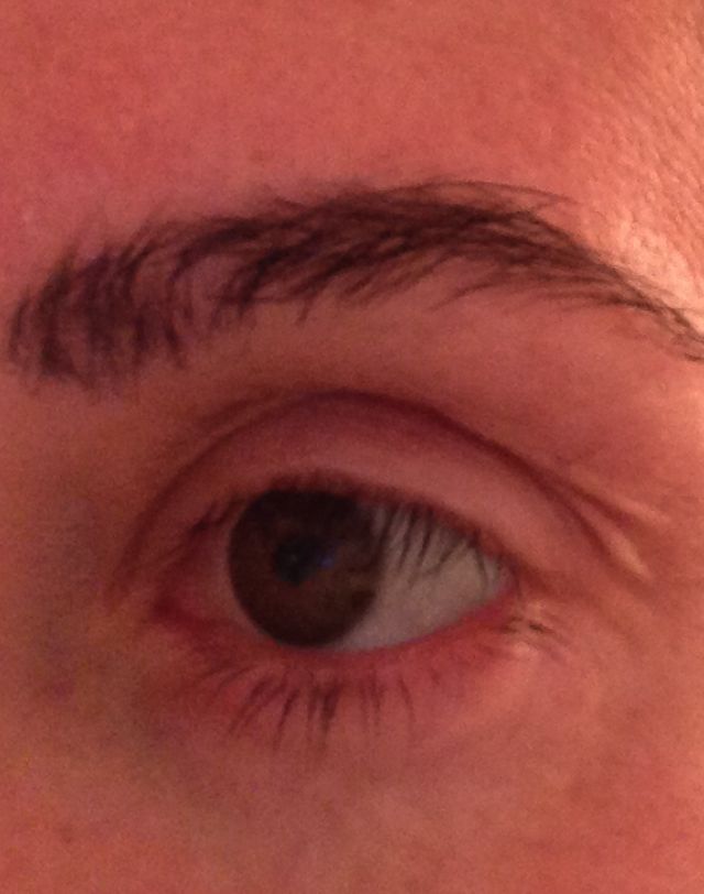 Chemo Biyatch: FALLEN EYEBROWS.