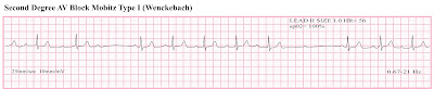 ECG Educator Blog : Second Degree AV Block Mobitz Type I (wenckebach)