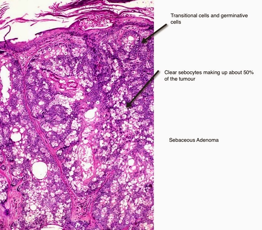 Dermpath Made Simple - Neoplastic: Sebaceous Tumours