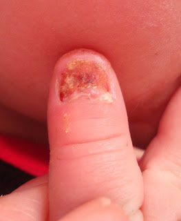 VIRTUAL GRAND ROUNDS IN DERMATOLOGY 2.0: Periodic Shedding of the Nails