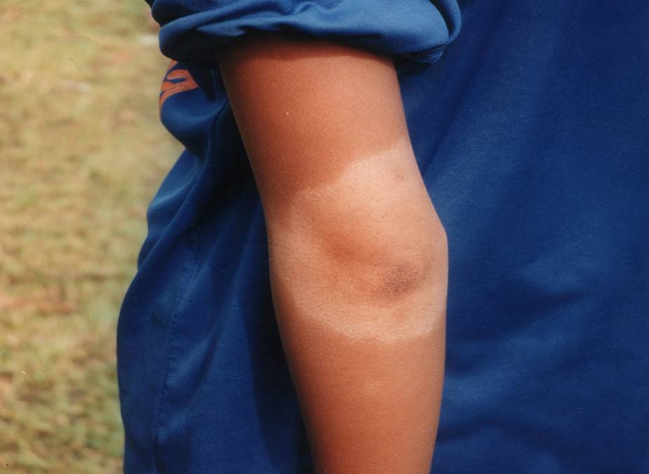 Doctorblog: KUSTA (LEPROSY) / MORBUS HANSEN