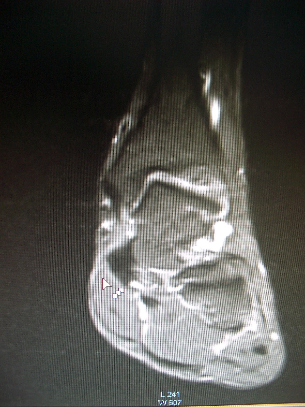 Podo Basas al Día: Fascitis plantar. Micosis intertriginosa. Papiloma ...
