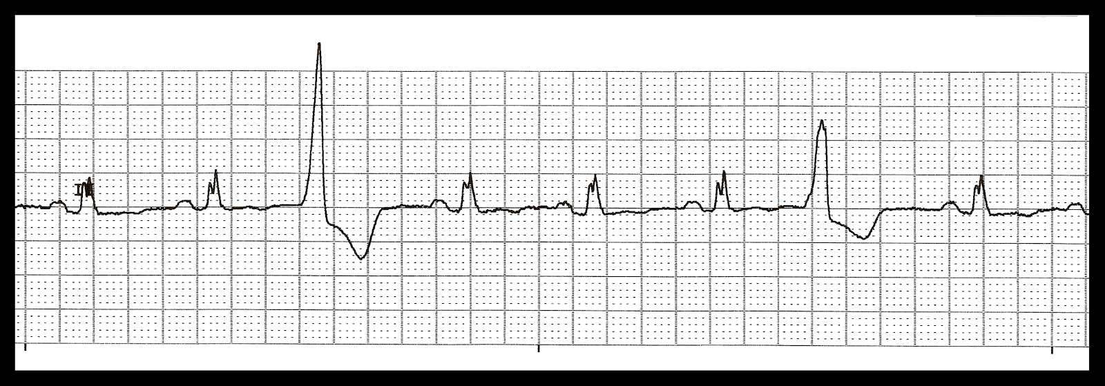 EKG Rhythm Quiz 241
