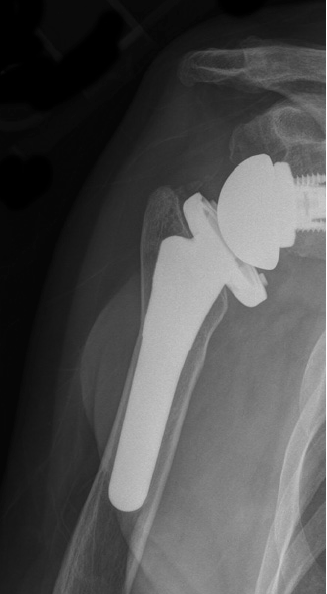 Shoulder Arthritis / Rotator Cuff Tears / Shoulder Pain : Short-stem ...