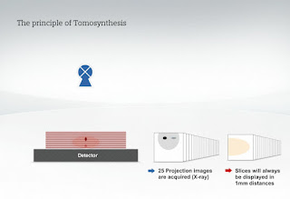 Tecnicos Radiologos: Tomosíntesis 3D: nuevo avance para pruebas ...