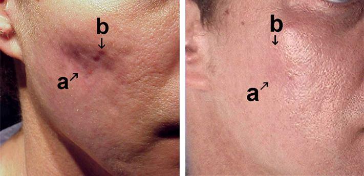 Best Acne Scars Treatment Products Causes Of Acne And Modern Treatment Acne Scars Removal Methods best-acne-scars-treatment-products-causes-of-acne-and-modern-treatment-acne-scars-removal-methods