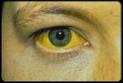 Penyebab Mata Kuning dan Cara Mengatasinya - KLIK TABIB