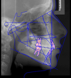 Realizamos tu Trazado Cefalométrico Digital - Brackets Veracruz ...