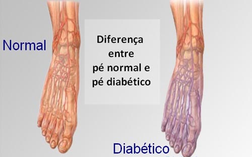Podologia e Fisioterapia geriátrica: Pé diabético