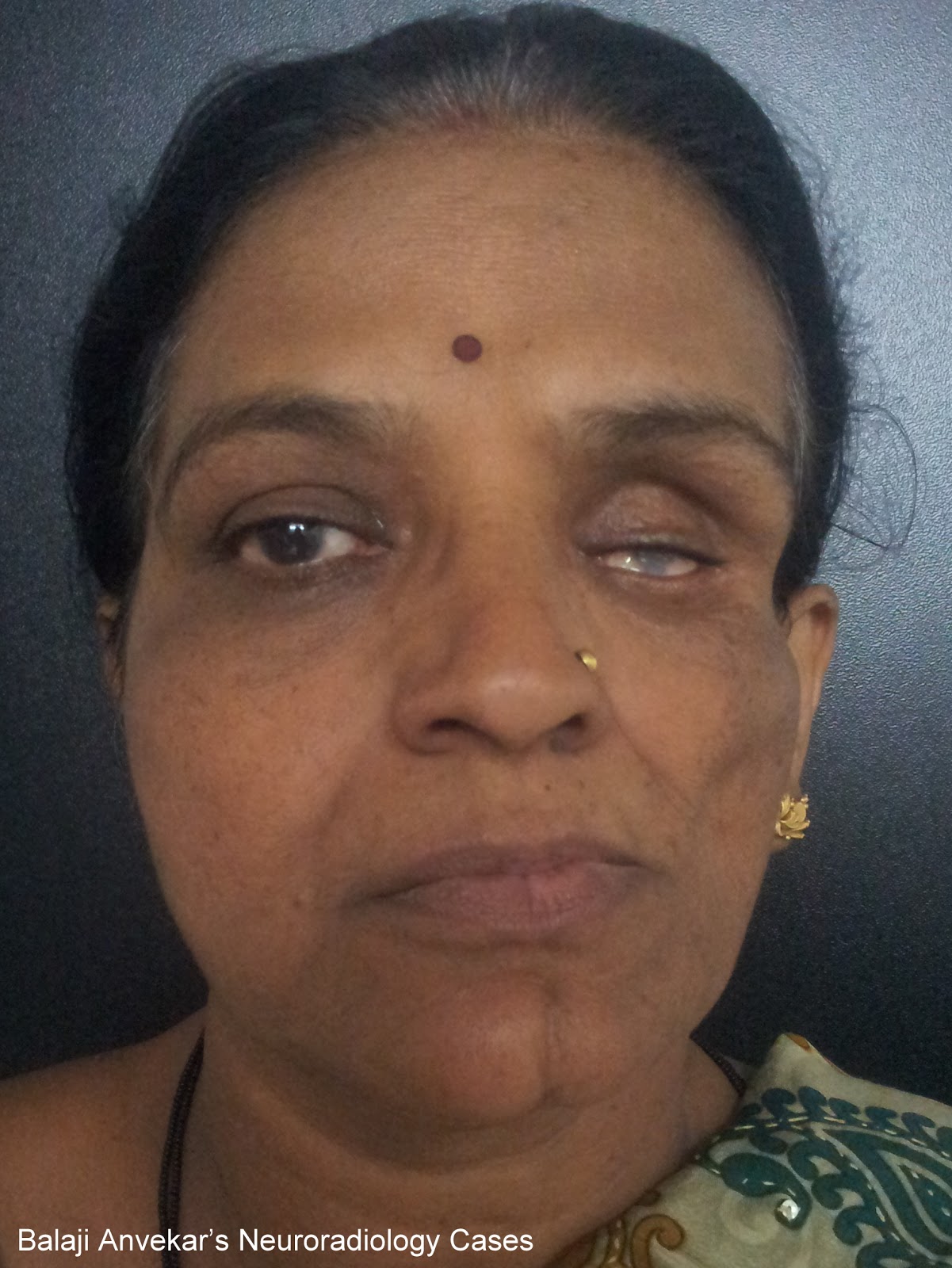 Dr Balaji Anvekar FRCR: Parry Romberg Syndrome