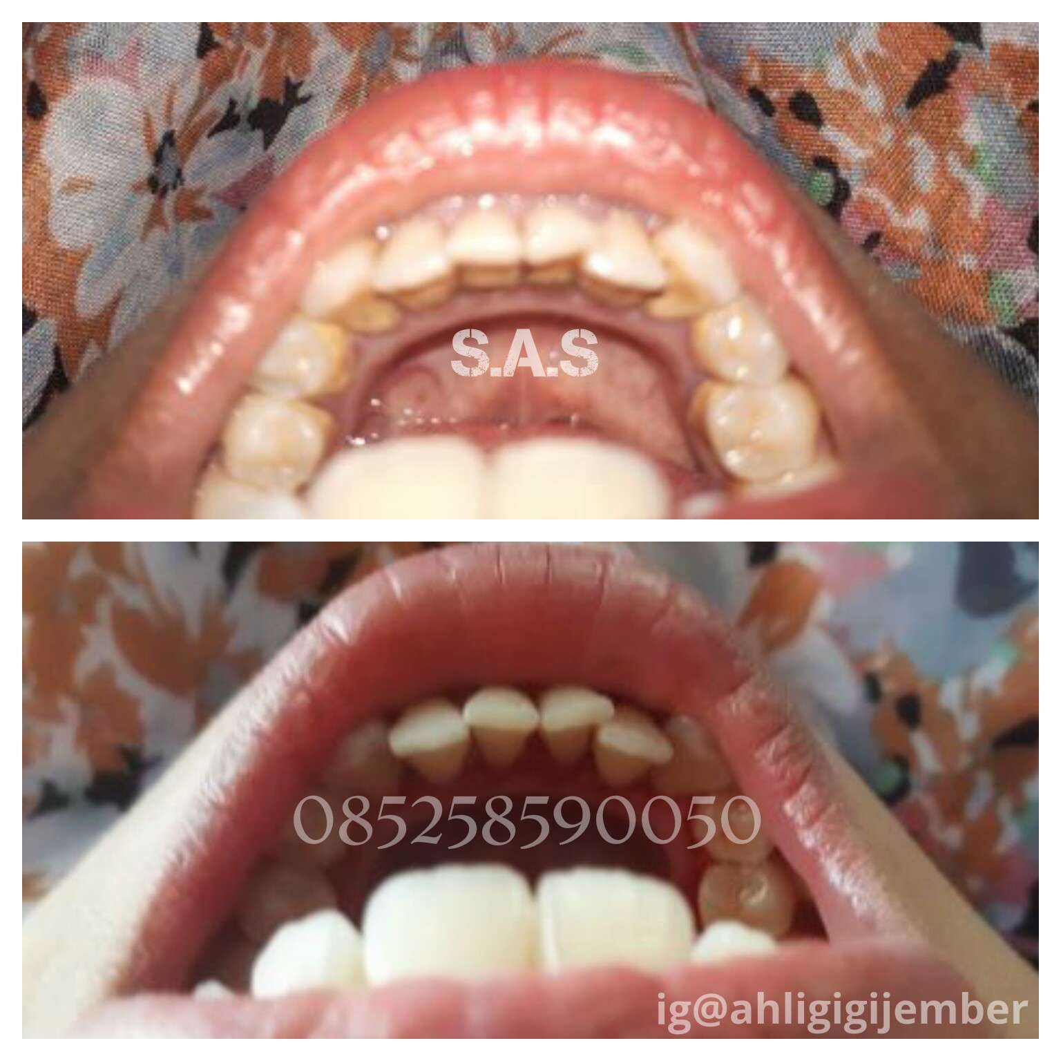 Foto Hasil Perbaikan Gigi Keropos, Berlubang Hitam Hingga Gigi Rapi dan ...