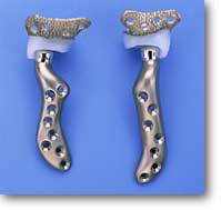 My TMJ replacement experience.: Total Concepts Implants