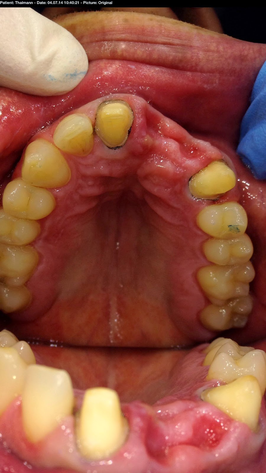 Zahnmedizin und Technik: Die Zirkon Krone oder VMK Krone