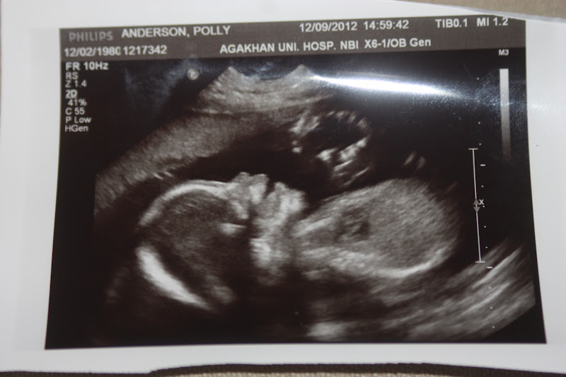 Baby Polly and Gregory: 20 weeks and 6 days scan