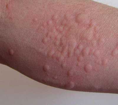 Qu'est-ce que l'urticaire et quelles sont les causes